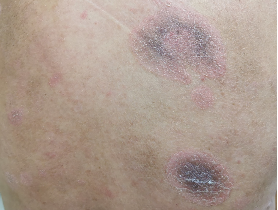 Differential Diagnosis of Mycosis Fungoides: A Review of Literature ...