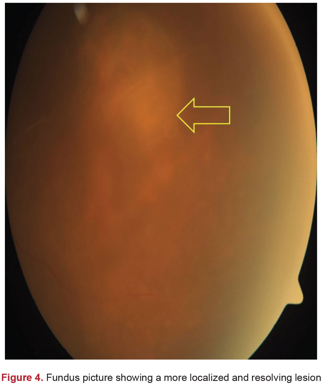 Metastatic chorioretinal abscess: an unusual complication of pyogenic ...