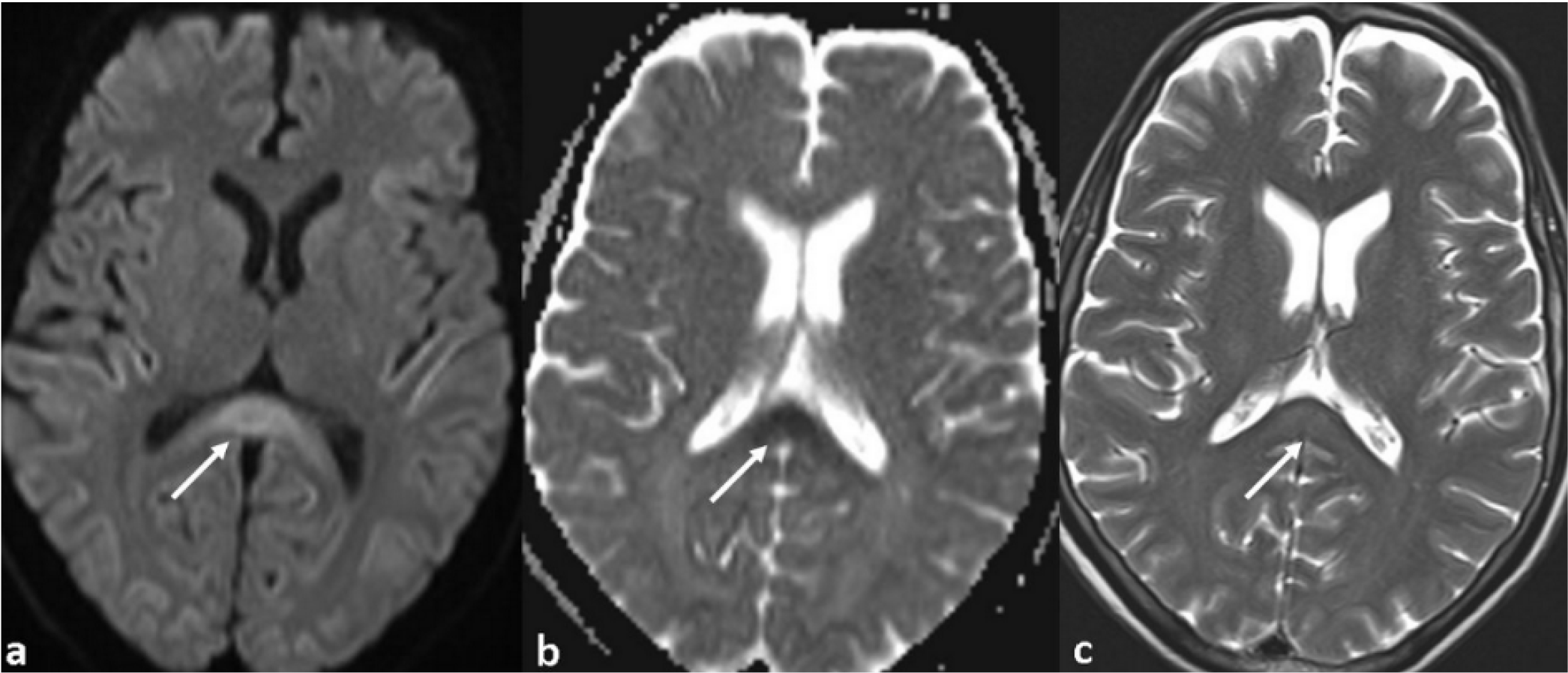 Cytotoxic Lesion of the Corpus Callosum Associated with 5-Fluorouracil ...