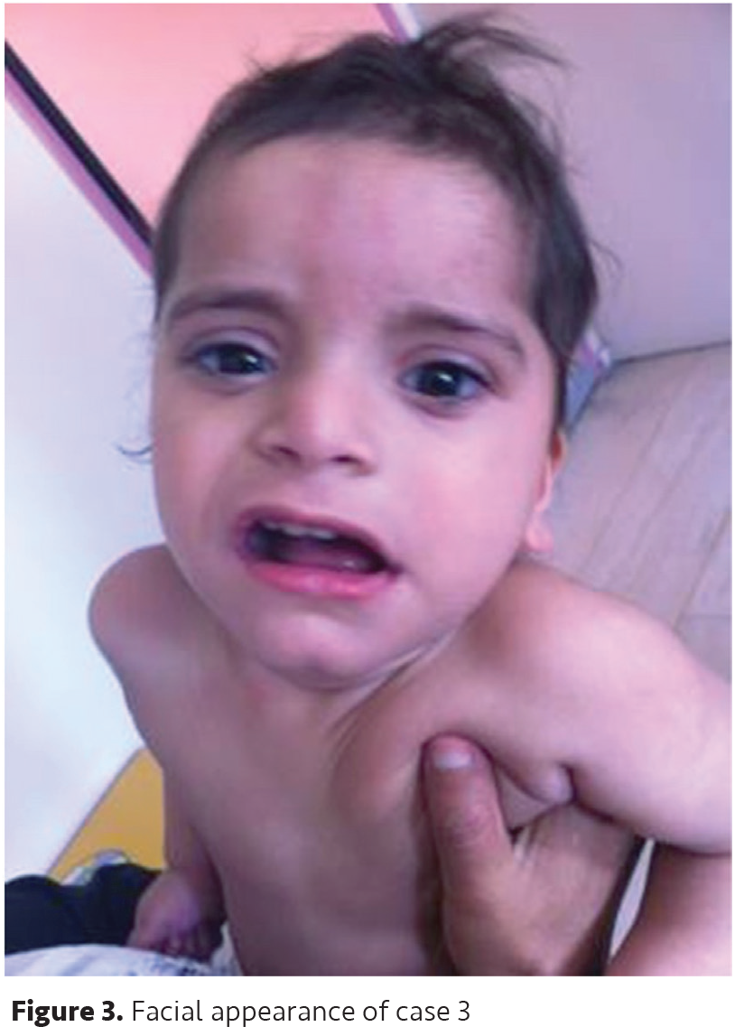 Evaluation of Six Patients with Chromosome 18 Structural Anomalies and ...