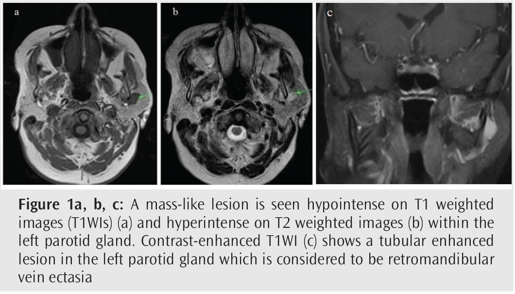 Retromandibular Vein Parotid Gland