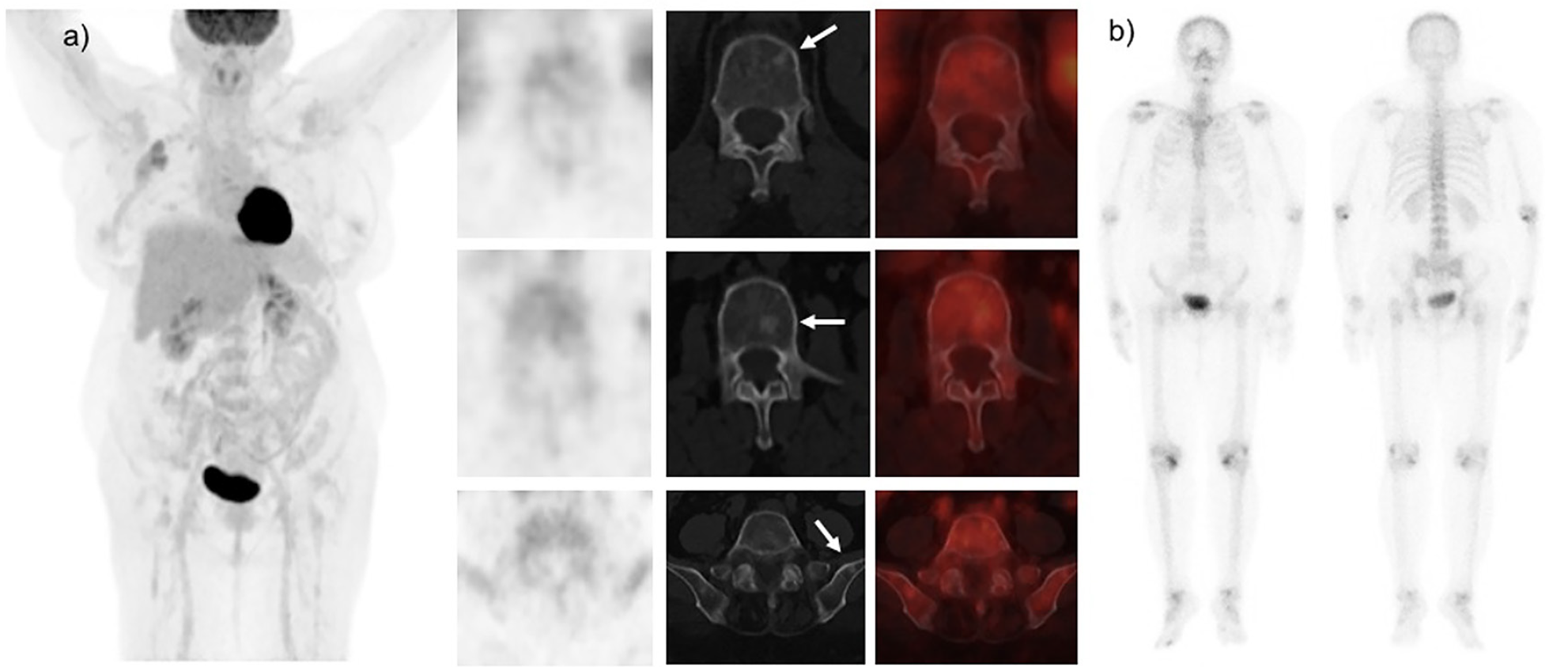 Unveiling the Diagnostic Mystery: 18F-FDG PET and Bone Scan Negative in ...