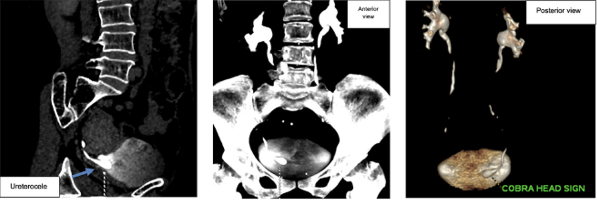 Ureterocele Radiopaedia