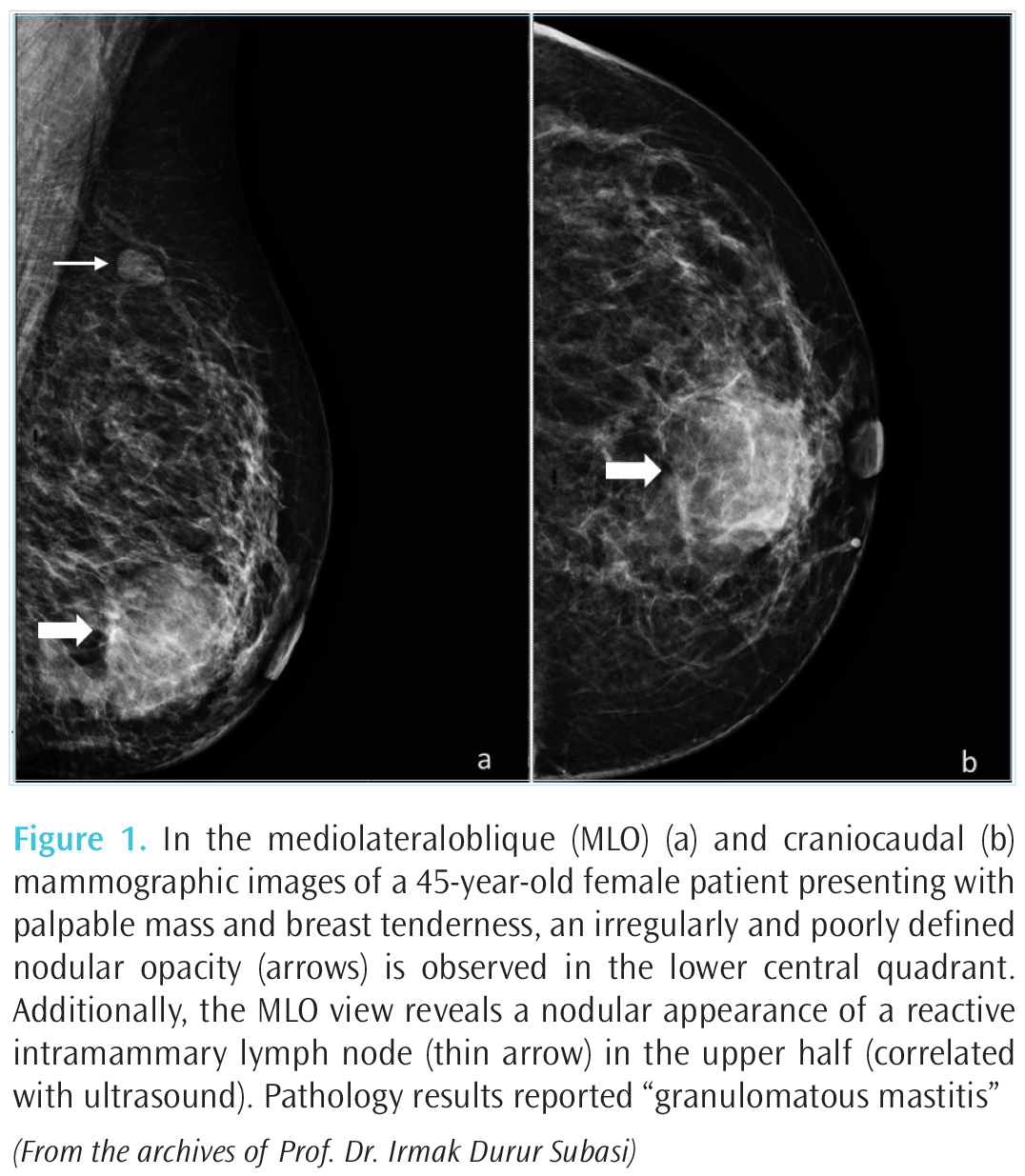 Idiopathic Granulomatous Mastitis: Overview and Imaging Findings - Advanced Radiology and Imaging