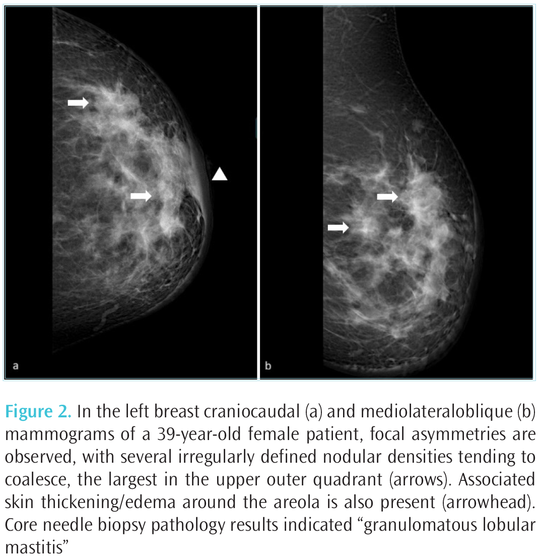 Idiopathic Granulomatous Mastitis: Overview and Imaging Findings - Advanced Radiology and Imaging