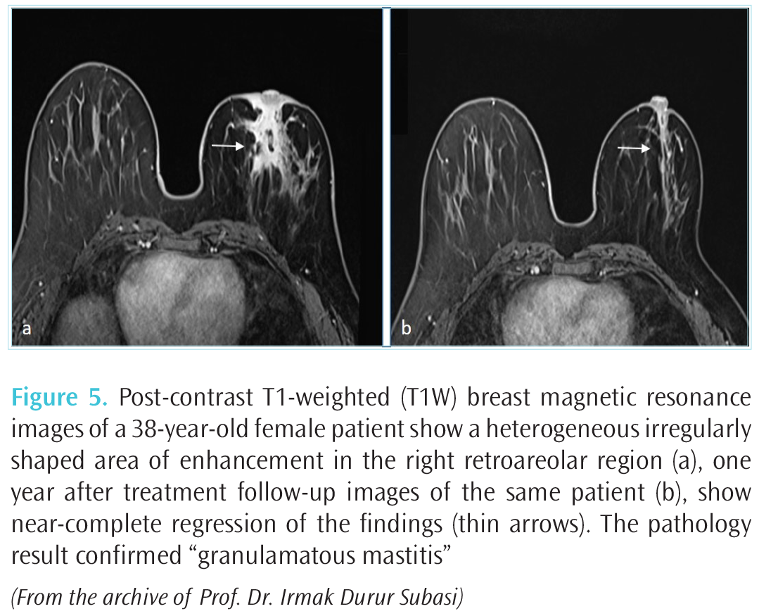 Idiopathic Granulomatous Mastitis: Overview and Imaging Findings ...