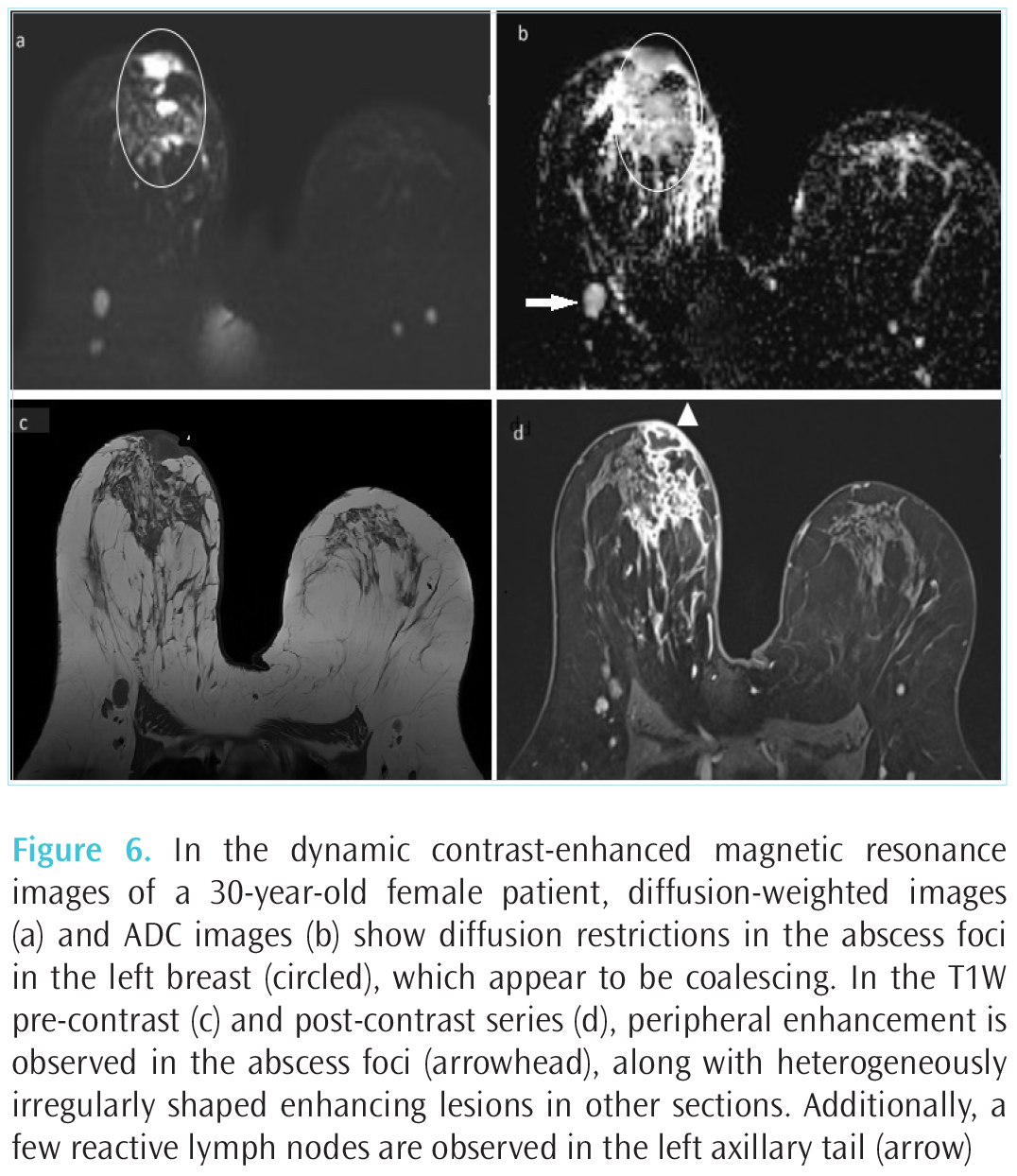 Idiopathic Granulomatous Mastitis: Overview and Imaging Findings ...