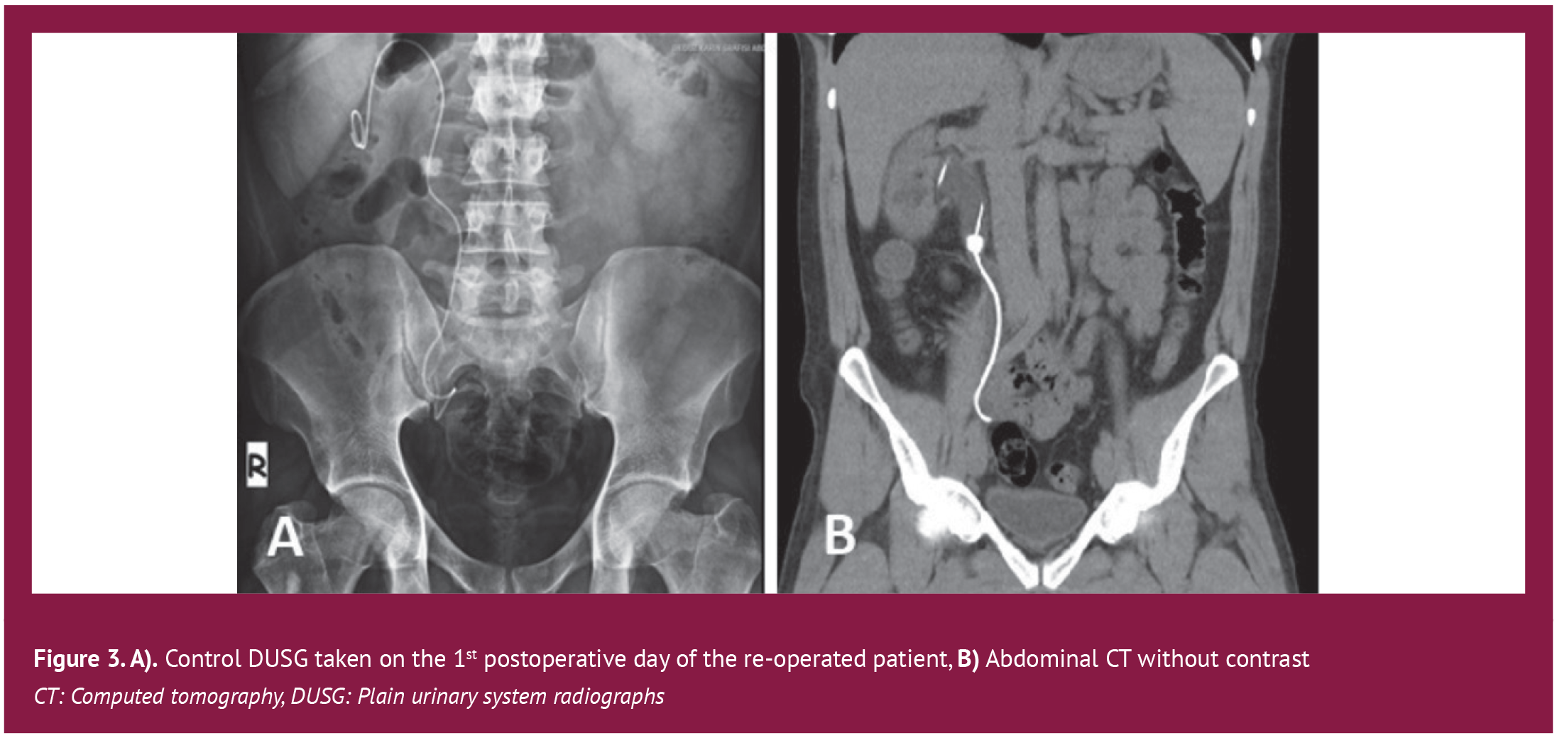 Travel Story of the Double-J Stent in the Patient - Hamidiye Medical ...