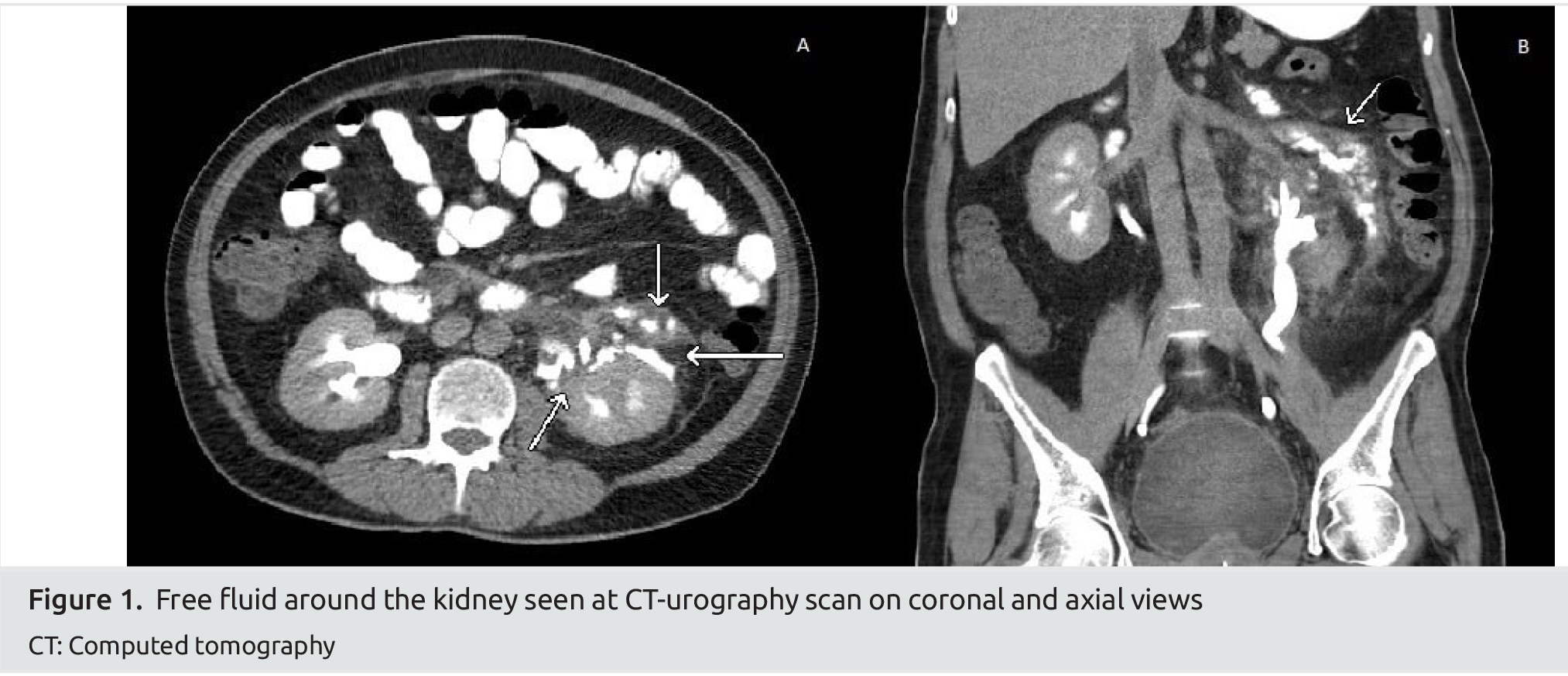 Spontanous Rupture of Renal Pelvis Due to Bladder Globe - Bezmialem ...