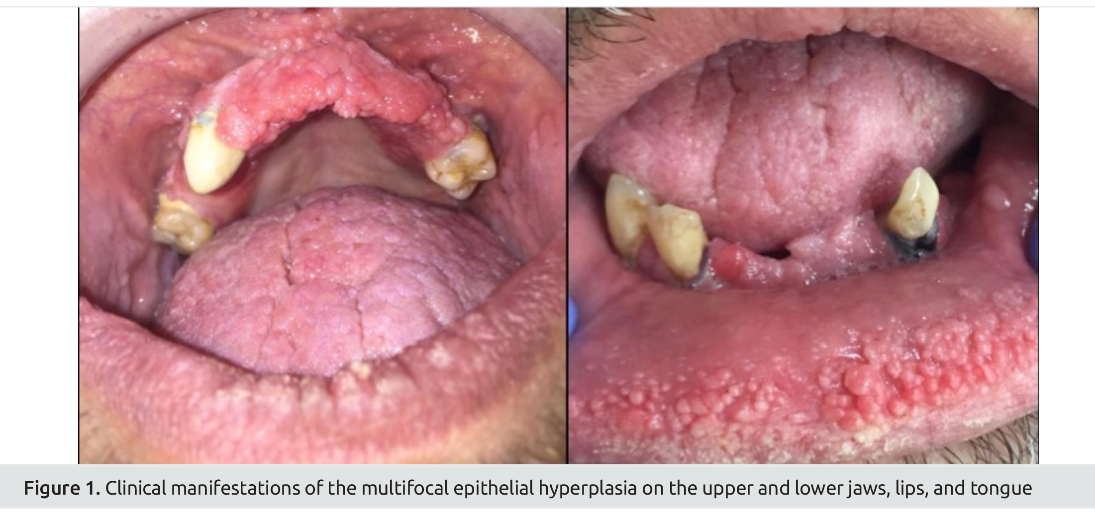 Multifocal, Non-Human Papillomavirus Inflammatory Papillary Hyperplasia ...