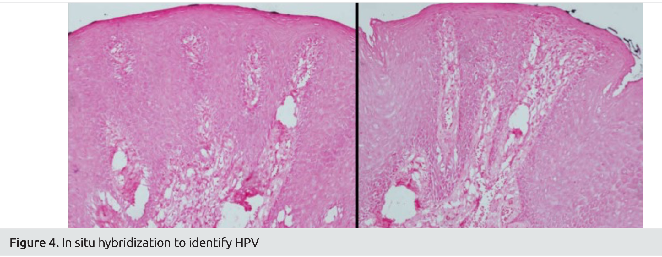 Inflammatory Papillary Hyperplasia Histology