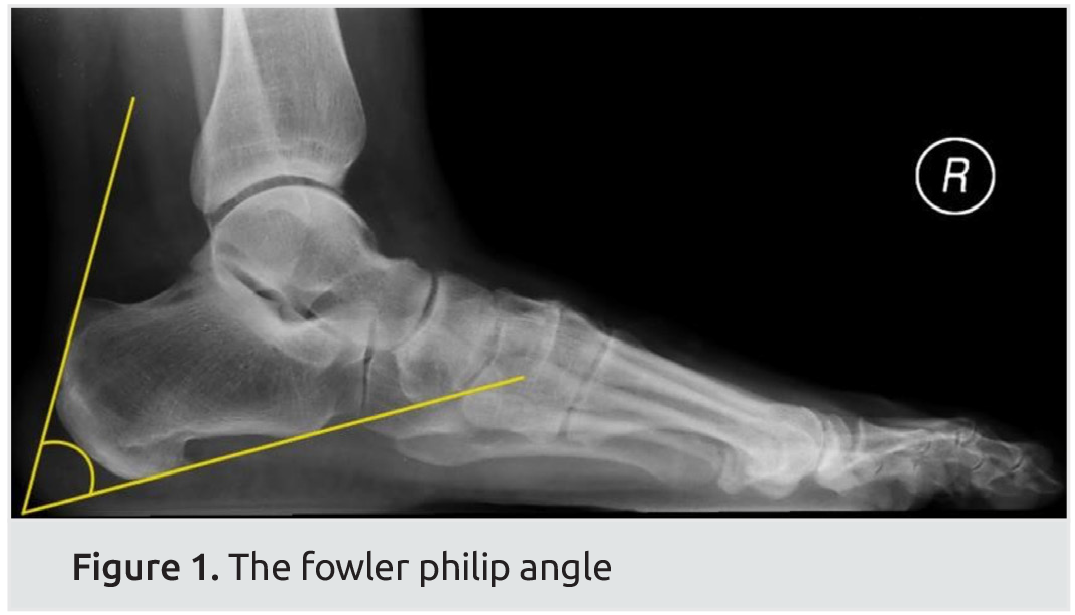 Assessment of Calcaneal Morphology and Radiological Parameters in ...