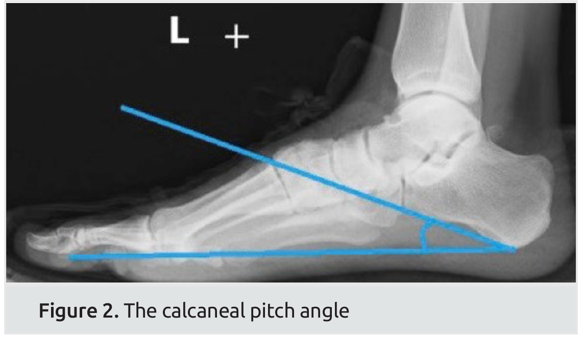Assessment of Calcaneal Morphology and Radiological Parameters in ...