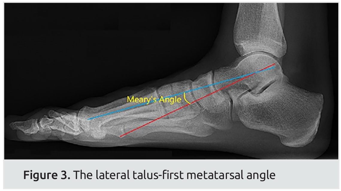 Assessment of Calcaneal Morphology and Radiological Parameters in ...