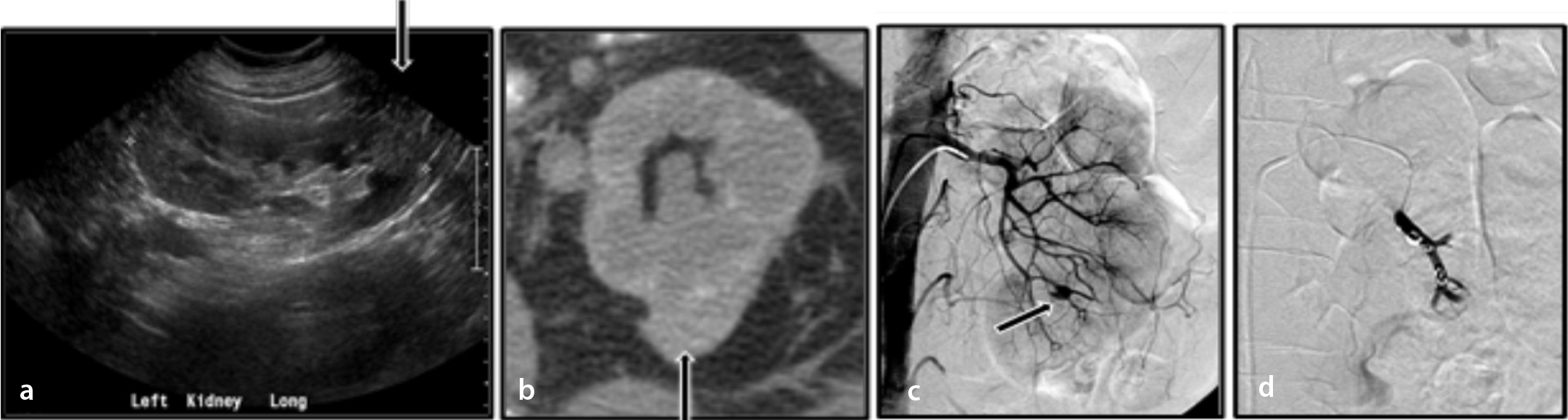 Kidney Imaging Radiology Imaging And Management Of Incidental Renal