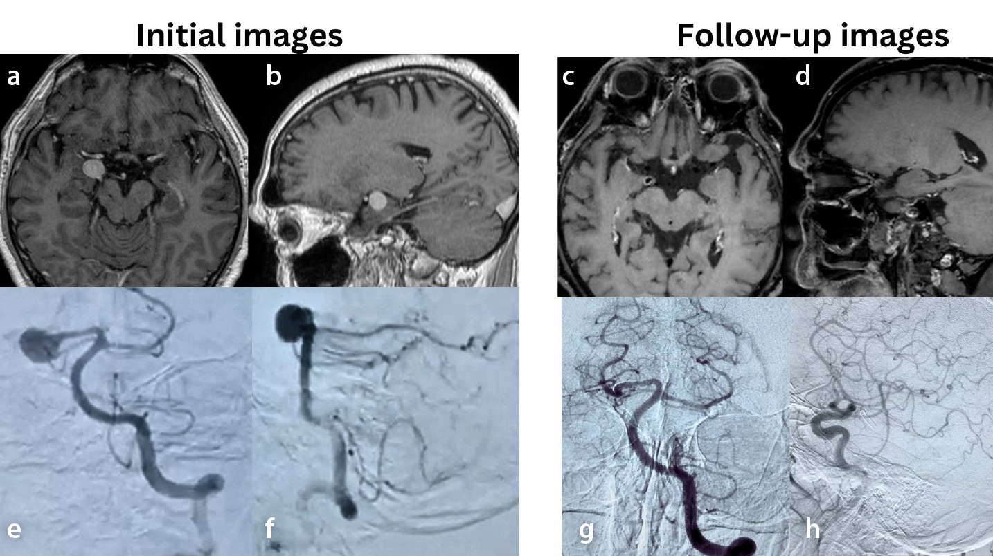 Safety and efficacy of flow diverter stents in the treatment of ...