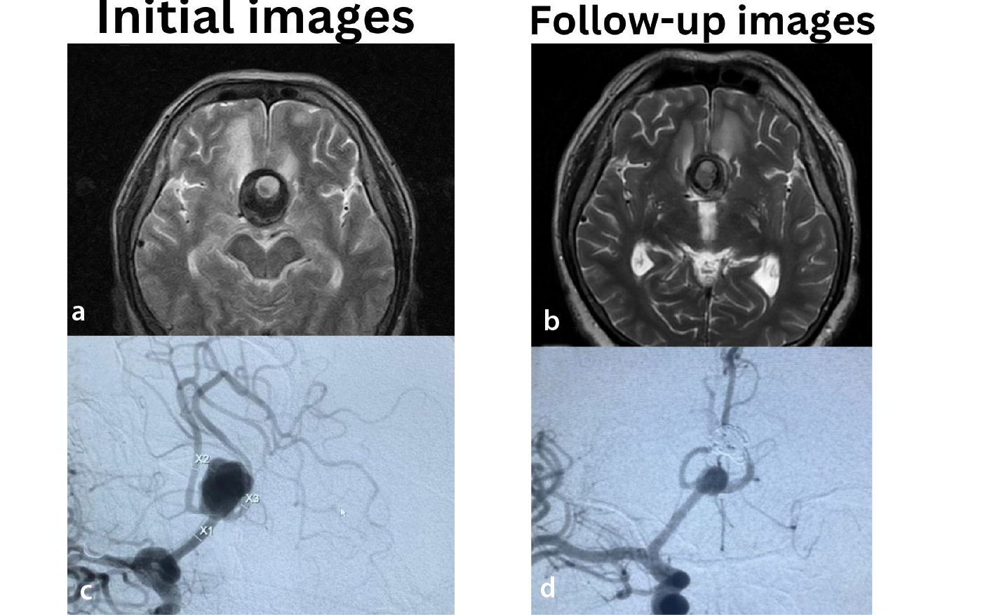 Safety and efficacy of flow diverter stents in the treatment of ...