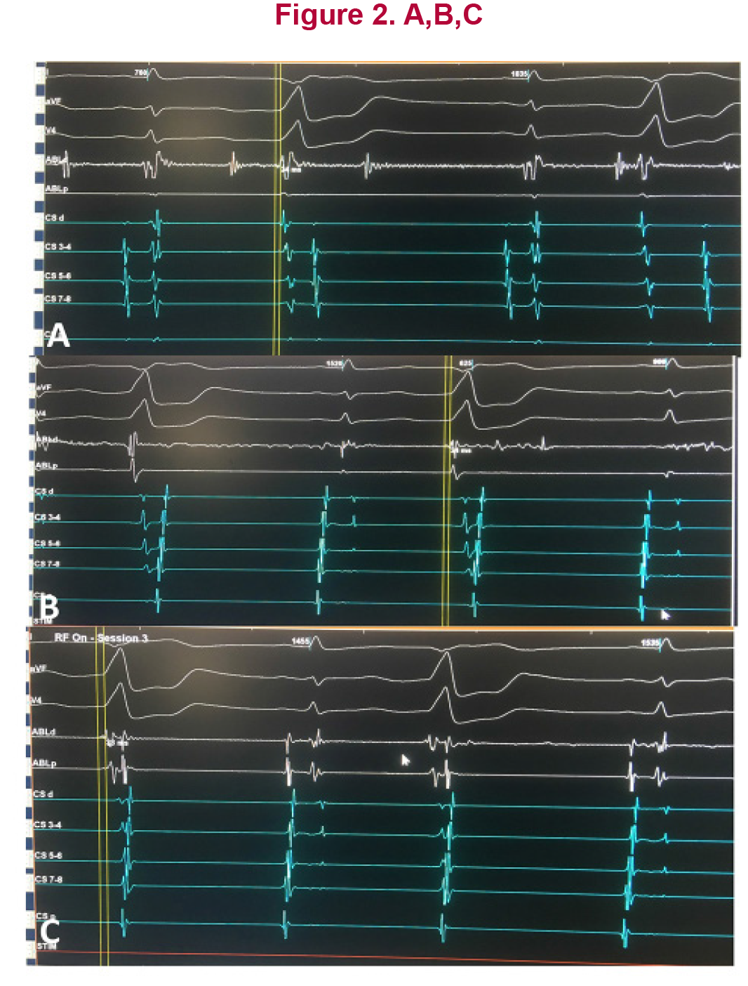 Idiopathic premature ventricular contractions originating from left ...