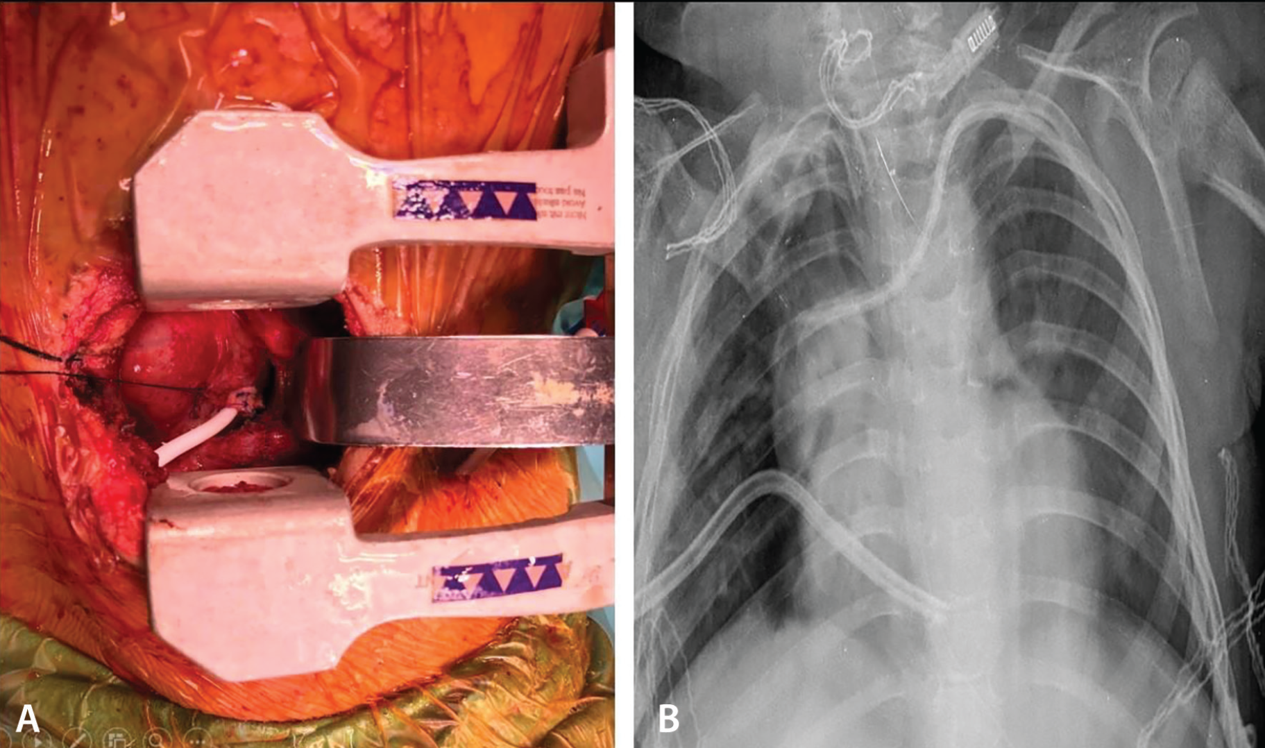 Intracardiac Access for Hemodialysis in Small Children: Final Options ...