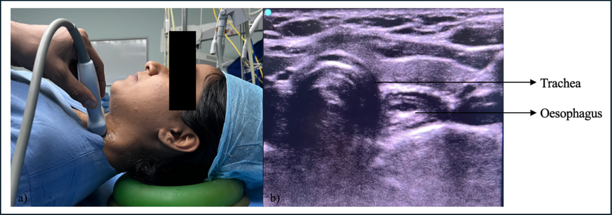 Focus on POCUS: Identification of Early Successful Intubation by Point ...