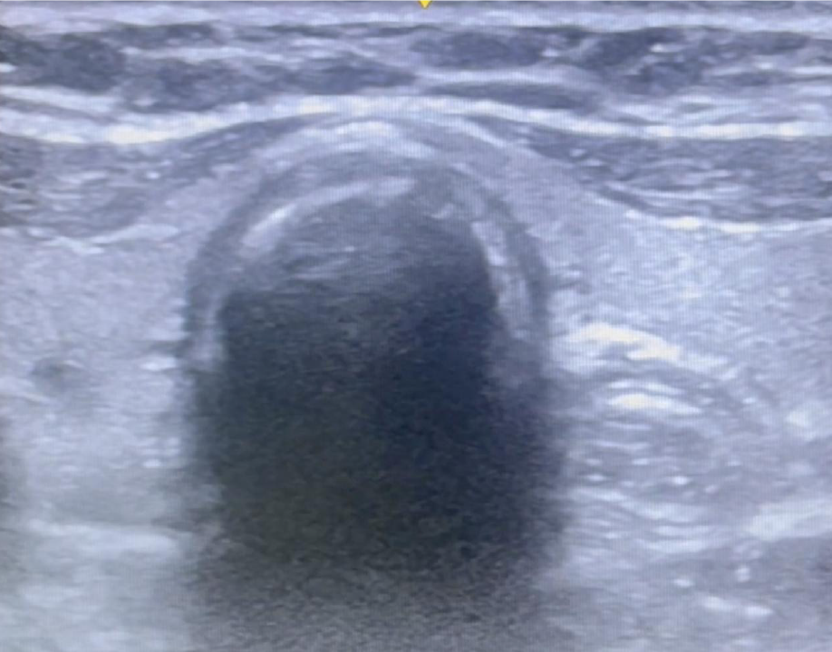 Focus on POCUS: Identification of Early Successful Intubation by Point ...