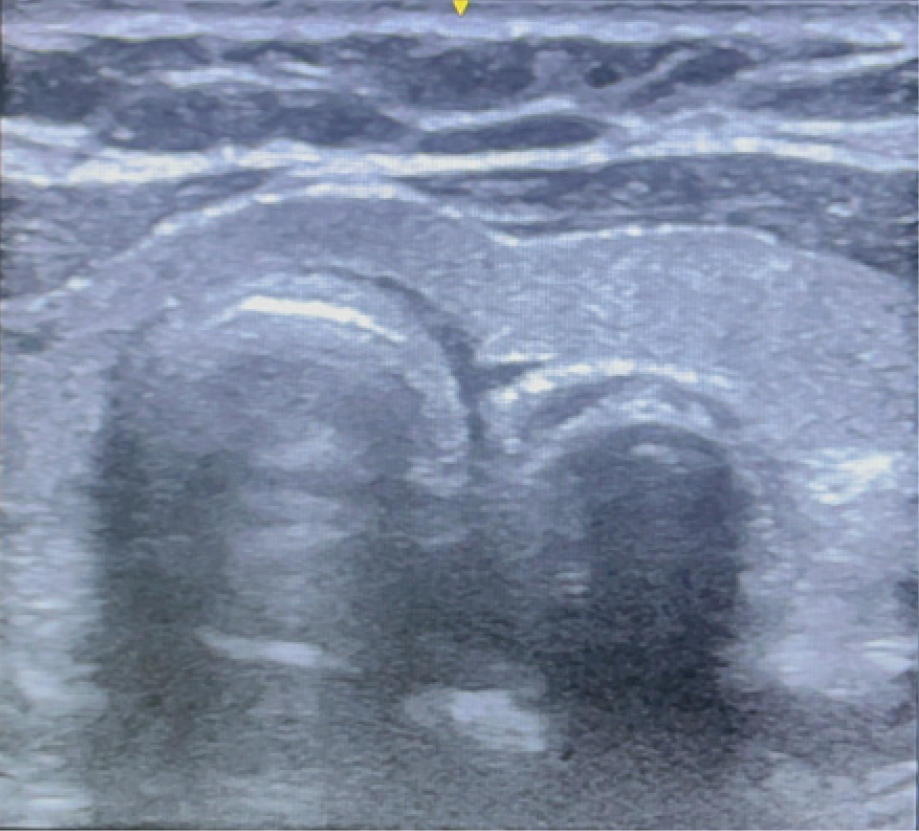 Focus on POCUS: Identification of Early Successful Intubation by Point ...