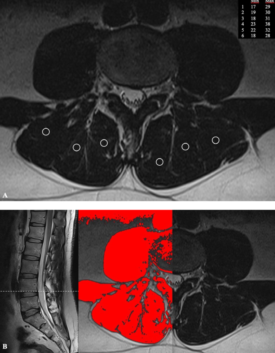 Magnetic Resonance Imaging- Defined Lumbar Paraspinal Muscle ...