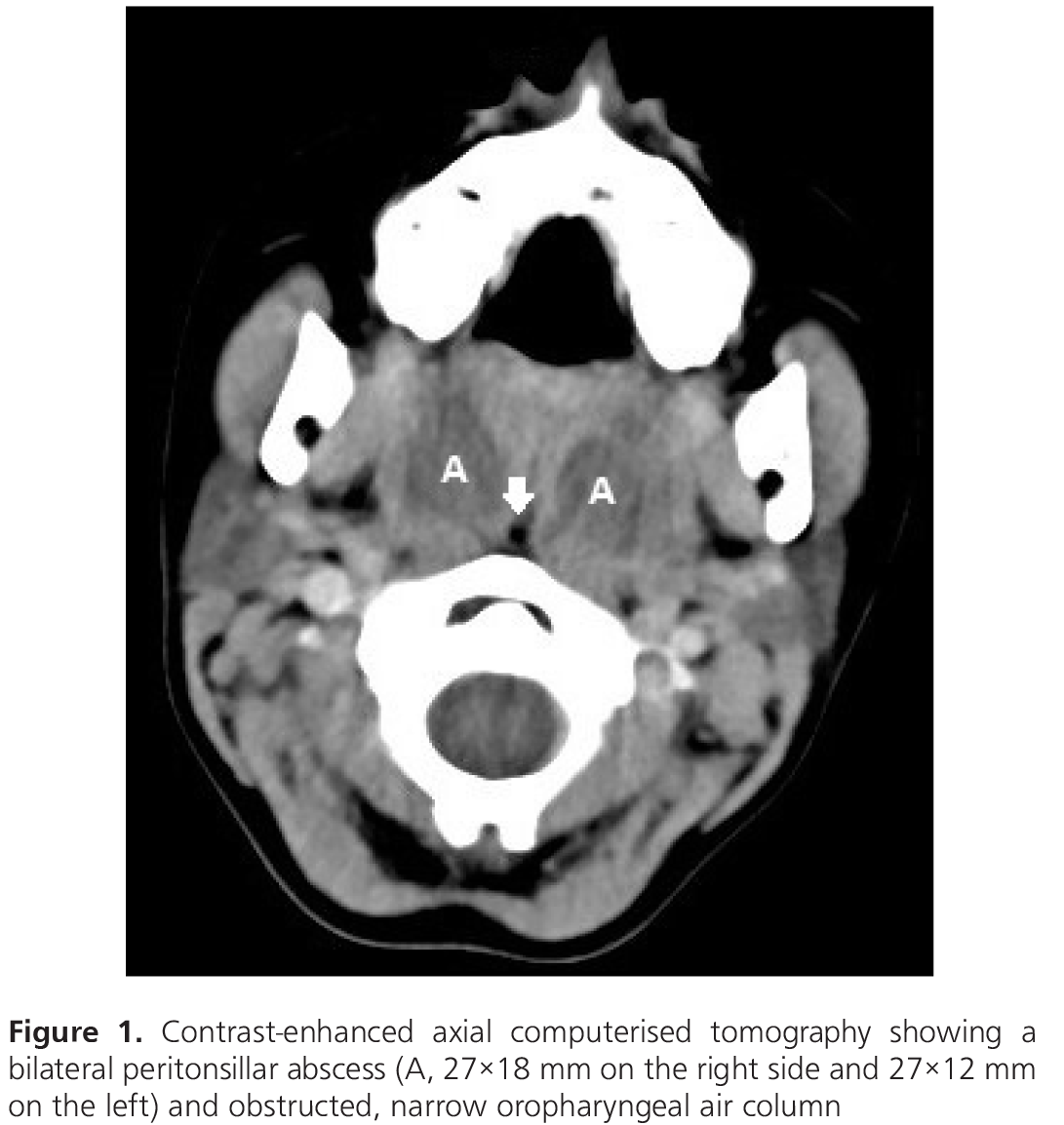 Peritonsillar Abscess Radiology