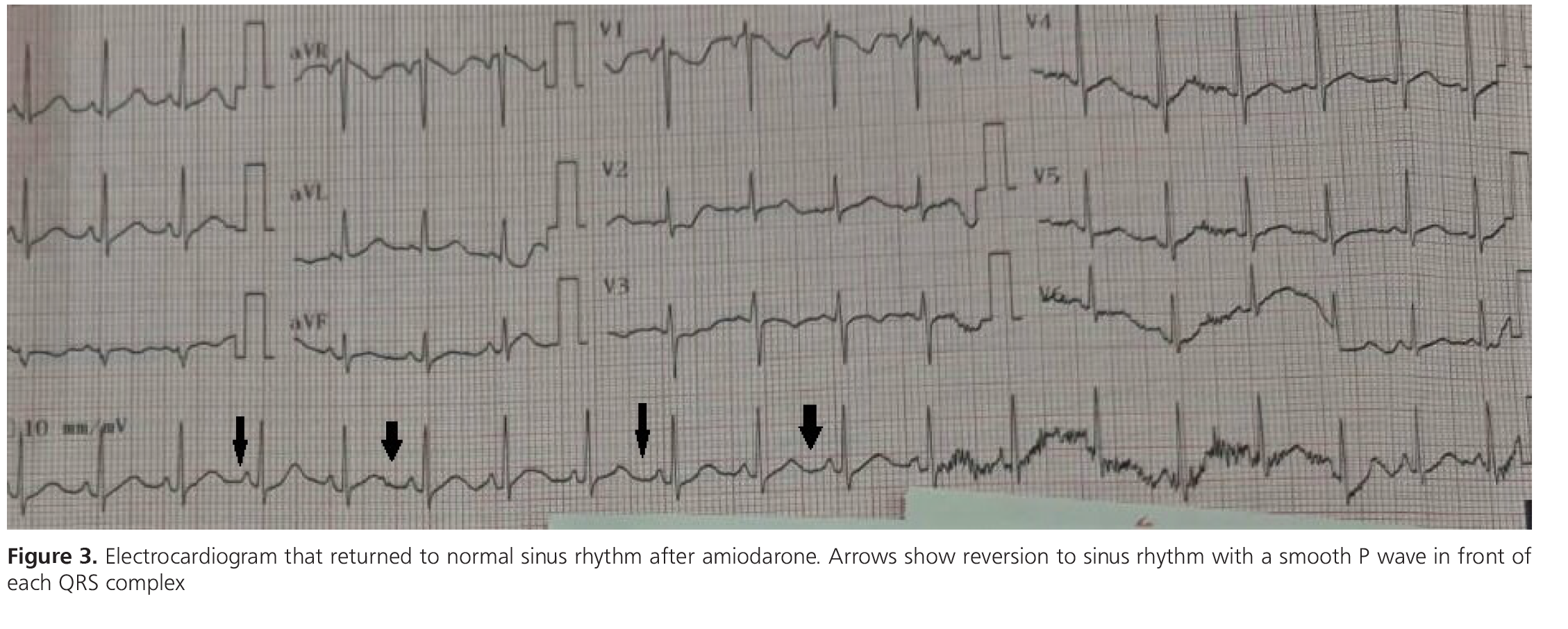 Efficacy of Adenosine in the Differential Diagnosis of Narrow QRS ...