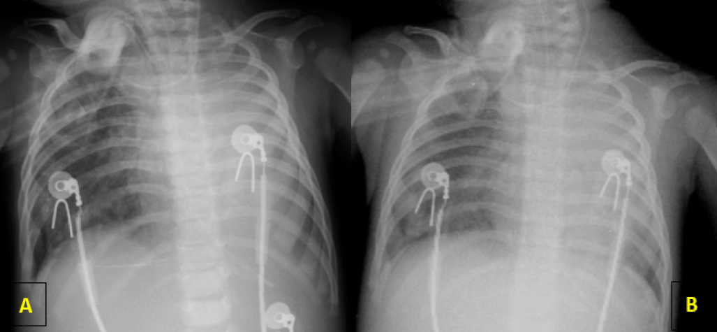Respiratory Support via Laryngeal Mask Airway in a Case with Treacher ...